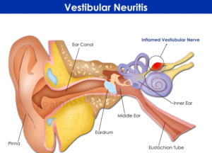 NEURITE VESTIBULAR – Dra Kênia Chaves
